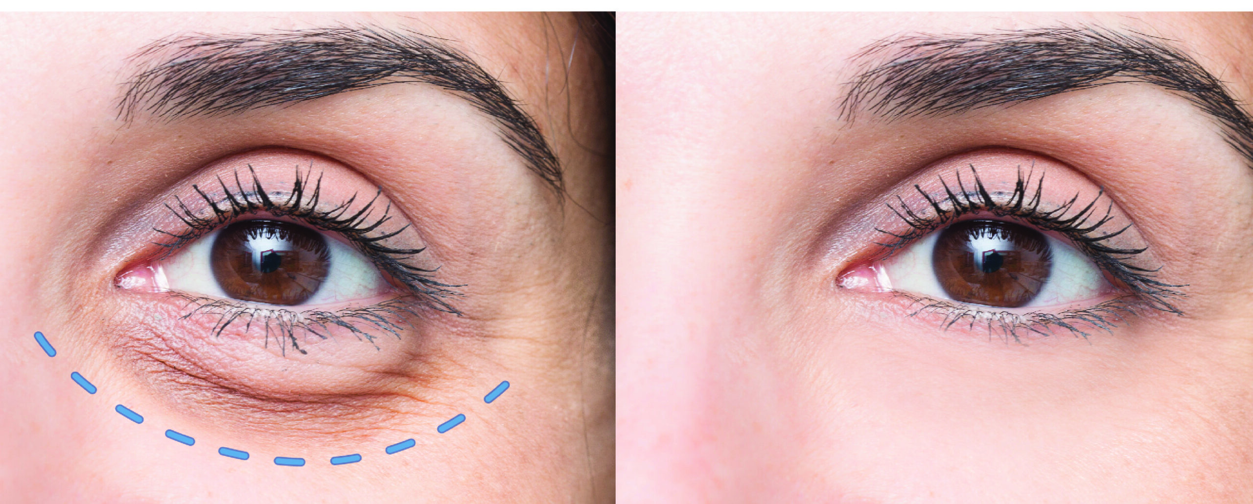 La oculoplastia rejuvenece la mirada y mejora la calidad de vida ...