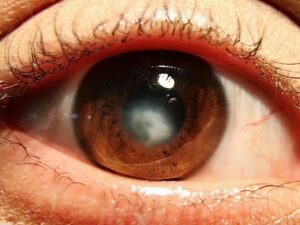 Leucoma corneal: ¿por qué es importante su diagnóstico temprano ...